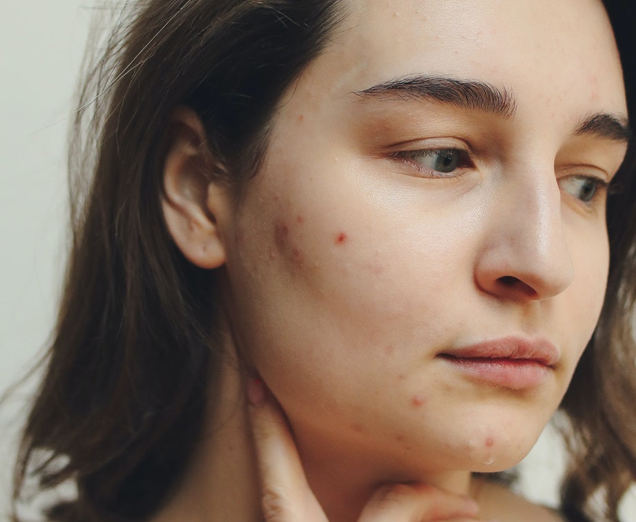 FOUR INGREDIENTS PROVEN TO HELP CLEAR ACNE-PRONE SKIN – Skinstitut AU FOUR INGREDIENTS PROVEN TO HELP CLEAR ACNE-PRONE SKIN – Skinstitut AU